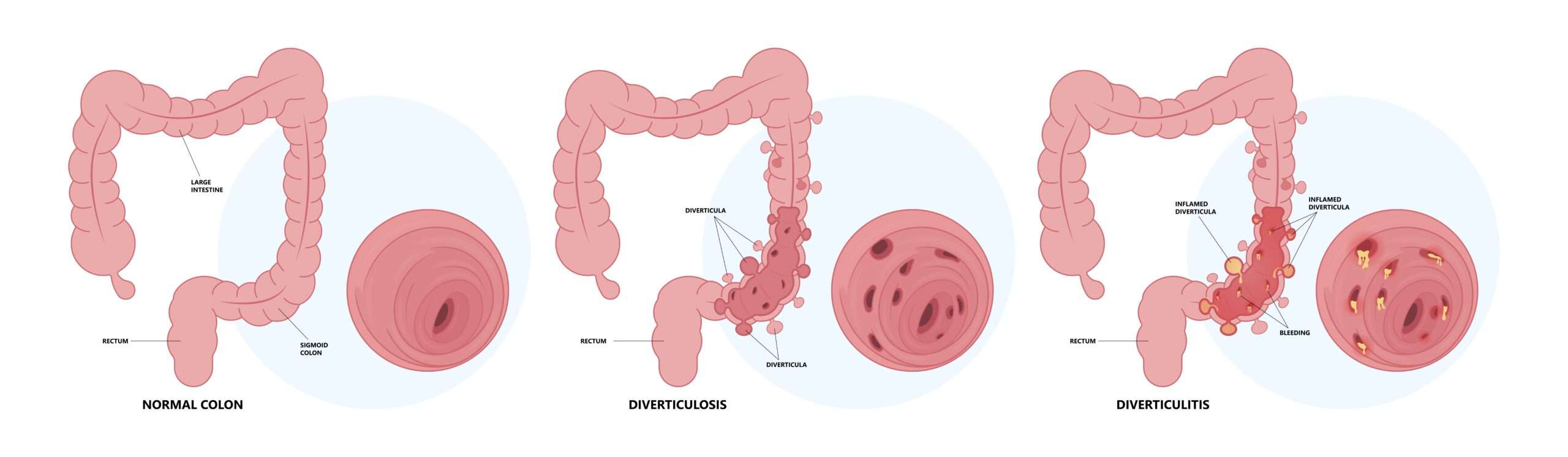 diverticulitis disease